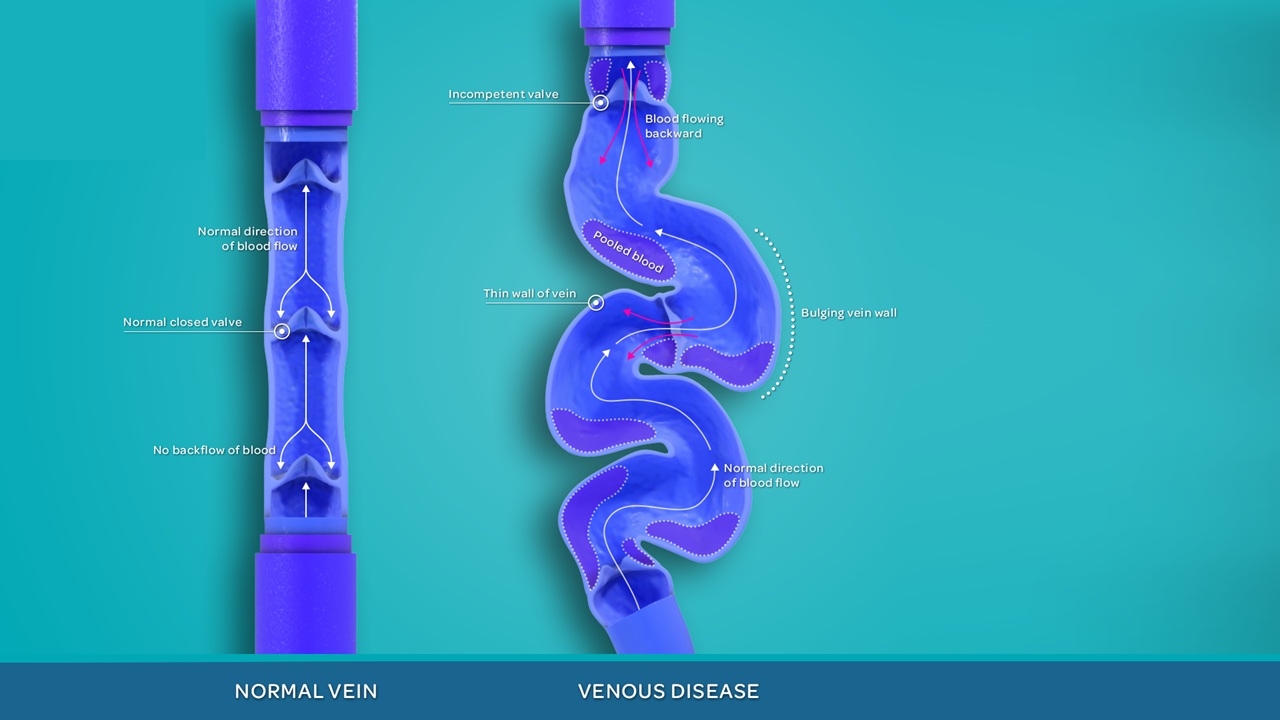 The InVera Infusion Device is an innovative catheter system designed ...